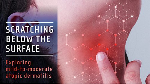 Scratching Below the Surface: Exploring mild-to-moderate atopic ...